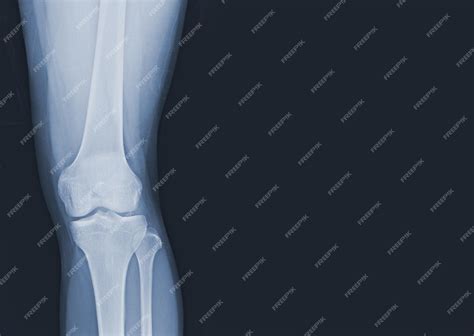 인간의 무릎 정상 관절과 인대의 필름 Xray 의료 이미지 개념 프리미엄 사진