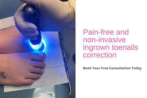 Onyfix Nail Correction Melbourne My Podiatrist