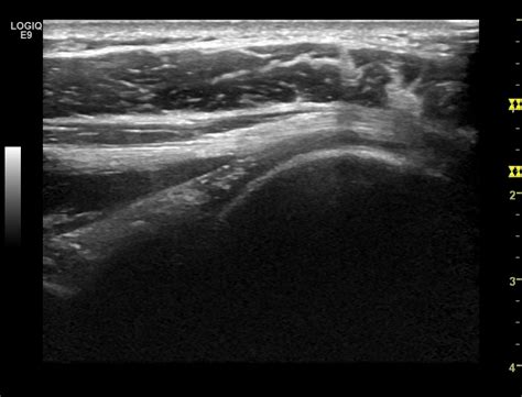 Cppd Infraspinatus Labral Calcifications Sonotool®