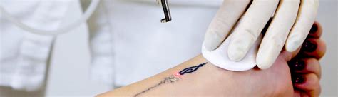 Remoção De Tatuagem A Laser Dermatologista Em São Paulo Dra Marcela
