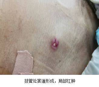 腹腔引流管拔管后5天内从严重渗漏到愈合良好，只因做了这些 腹腔 引流管 愈合