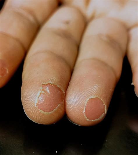 Skin Peeling Causes Symptoms And How To Reduce It