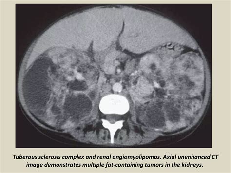 Presentation1 Radiological Imaging Of Tuberous Sclerosis Pptx