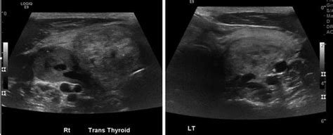 Multinodular Goiter Oncohema Key