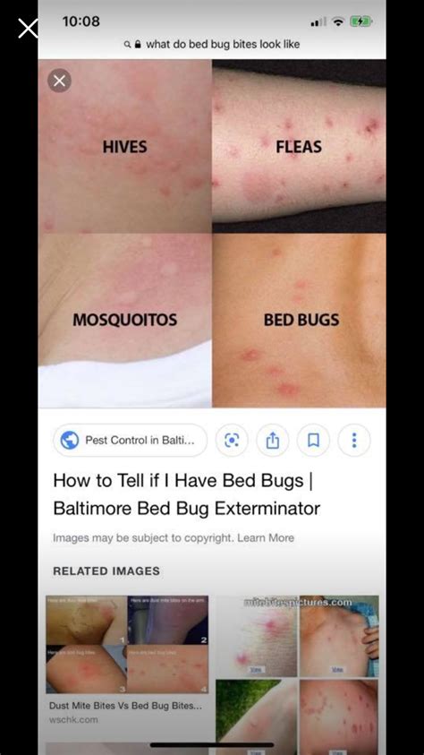 Bed Bug Bites Pictures On Black Skin