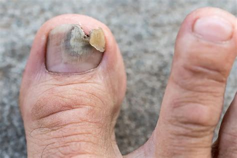 17 Causes Of Foot Pain While Running And Top Podiatry Treatments