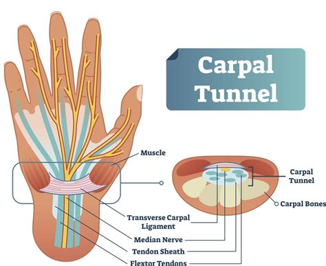 Carpal Tunnel Syndrome Exercises After Surgery What To Expect Harley