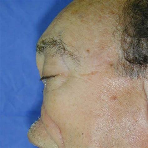 RBCP Evaluation Of Max Pereira Alar Reconstruction Technique