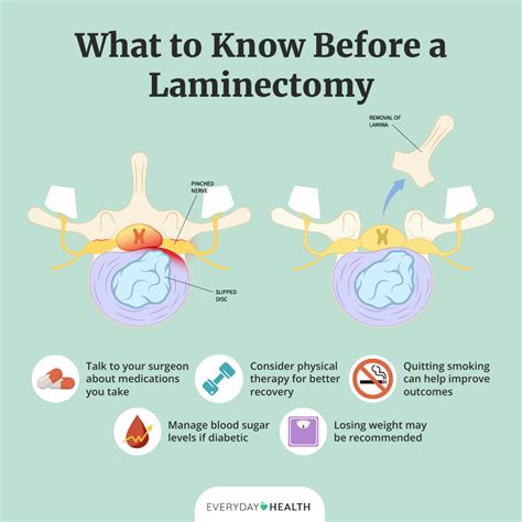 Hemilaminectomy Vs Laminectomy
