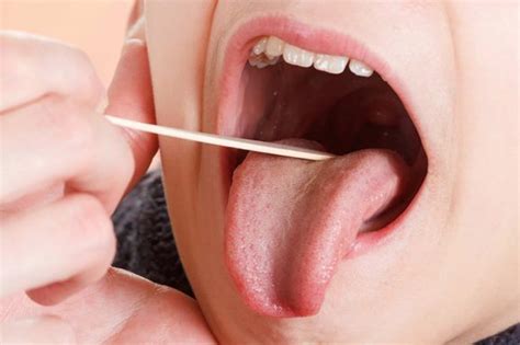 Viêm Họng Có Mủ Nguy Hiểm Không Nguyên Nhân And điều Trị