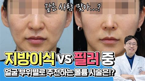 얼굴 볼륨시술엔 지방이식 필러 부위 별로 추천해드림🙌 Feat 보정 어플 쓰면 이래서 예뻐 보이네 Youtube