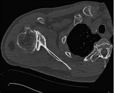 44 Patient Specific Instrumentation Facilitates Glenoid Replacement In