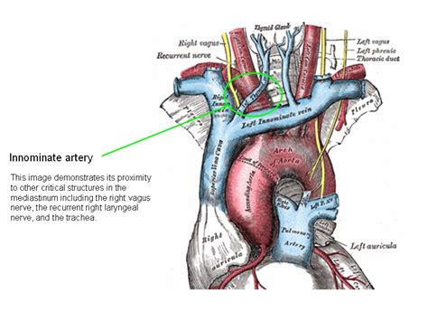 The Pump And The Tubes Innominate Artery Aneurysm