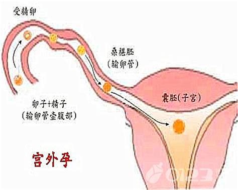 宮外孕的早期症狀是什麼？如何預防宮外孕？ 每日頭條