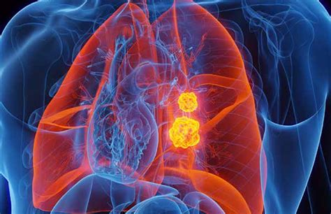 Immunotherapy Combos Are Vetted In Neoadjuvant Nsclc