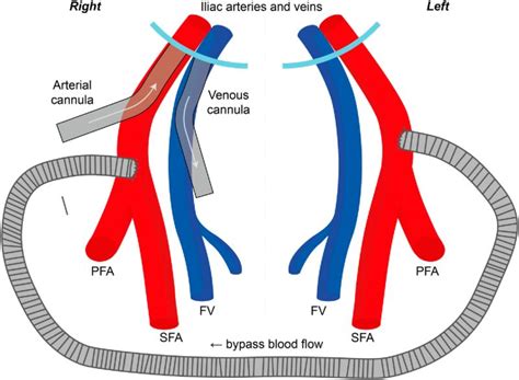 Critical Care Reviews On Linkedin Evolution Of Distal Limb Perfusion