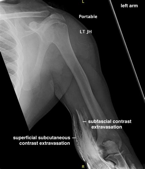 Upper Extremity Contrast Extrav Xray 1 Annotated Jetem 2019 Jetem