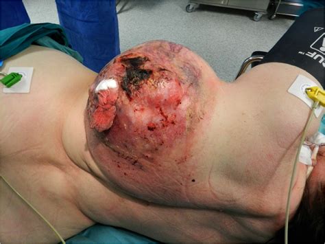 The Bleeding Necrotic Tumor Mass On The Left Posterolateral Surface Of Download Scientific