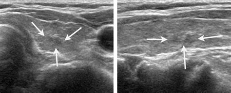 Heterogeneous Echogenicity Of The Underlying Thyroid Parenchyma How