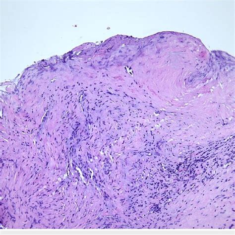 Tissue Composed Of Relatively Bland Spindle Shaped Cells Arranged In
