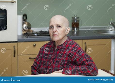 Hair Loss Patient After Chemotherapy Stock Image Image Of Radiation