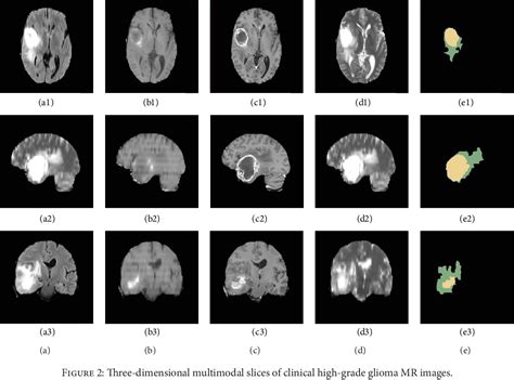 figure 2 from multimodal brain tumor segmentation based on dirichlet