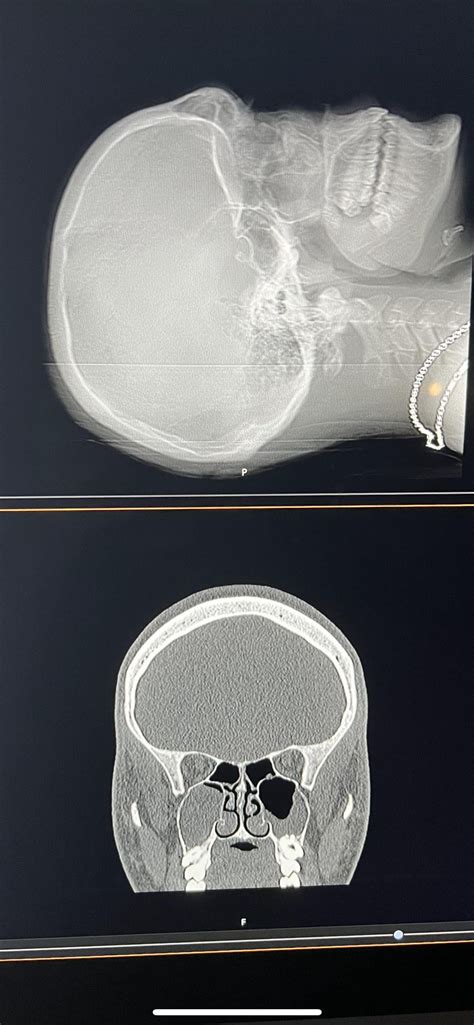 Post Sinus Surgery Rsinusitis