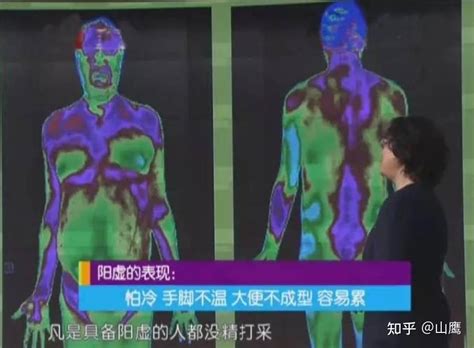 红外热像仪的医学应用，不健康的人体热像图是怎样的？ 知乎