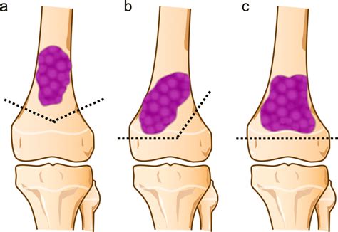 Diagram Showing The Classification Of Tumor Excision To Preserve The