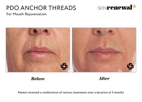 Pdo Threading Pdo Threads Threadlift Skin Renewal