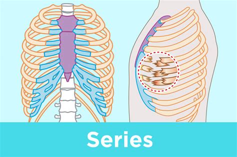 Fractured Broken Ribs Symptoms