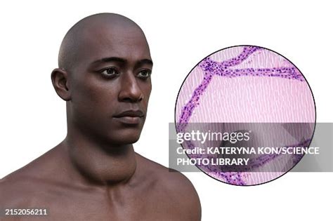 Endemic Goitre Of Thyroid Gland 3d Illustration High Res Vector Graphic
