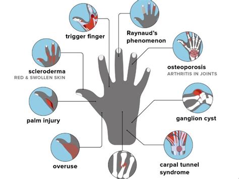 Crest Syndrome Scleroderma Basic Science Orthobullets
