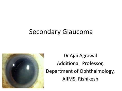 Secondary Glaucoma Finalpptx