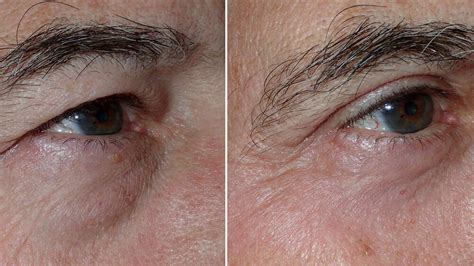 نابینا شدن مرد جوان هنگام رابطه زناشویی با همسرش علت چه بود؟ عکس