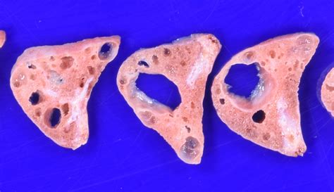 Pathology Outlines Sequestrations