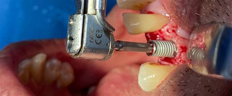 Flapless Versus Flapped Implant Placement