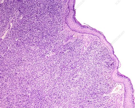 Human Pleomorphic Sarcoma Light Micrograph Stock Image C061 3396 Science Photo Library