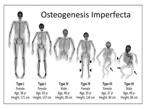 Osteogenesis Imperfecta Samarpan Physiotherapy Clinic Ahmedabad