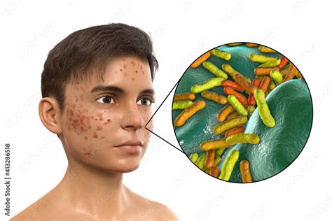 Acne Vulgaris And Bacteria Cutibacterium Acnes Stock Illustration Adobe Stock