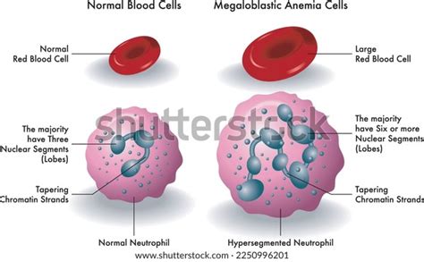 Medical Illustration Shows Difference Between Normal Stock Vector Royalty Free 2250996201