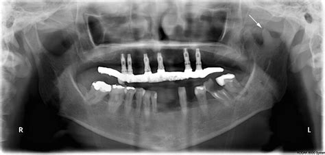 Coronoid Process Radiograph Direct Anterior Approach For Mini Plate