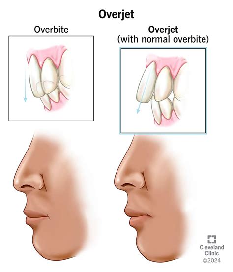 Whats The Difference Between An Overbite And An Overjet Corrective