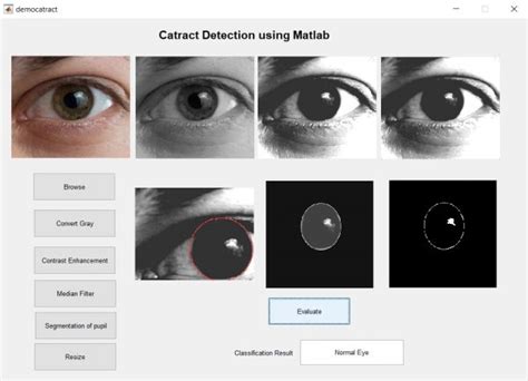 Automatic Eye Cataract Detection Algorithm Using Matlab