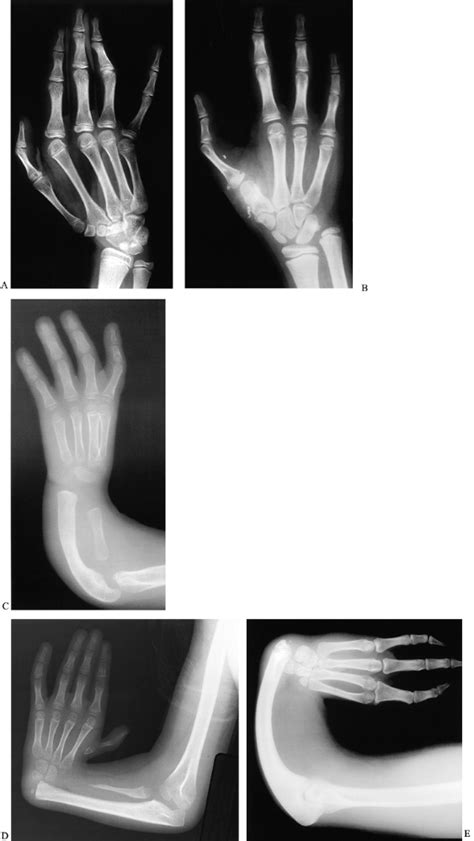 Congenital Hand Malformations Teachme Orthopedics