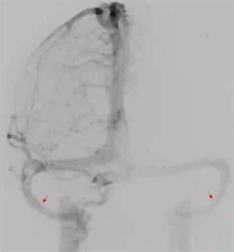 Sinus Sigmoideus Ars Neurochirurgica