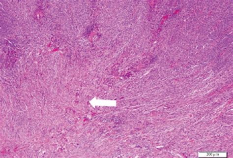 Case 2 A Microscopically The Tumor Reveals Fibroblastic
