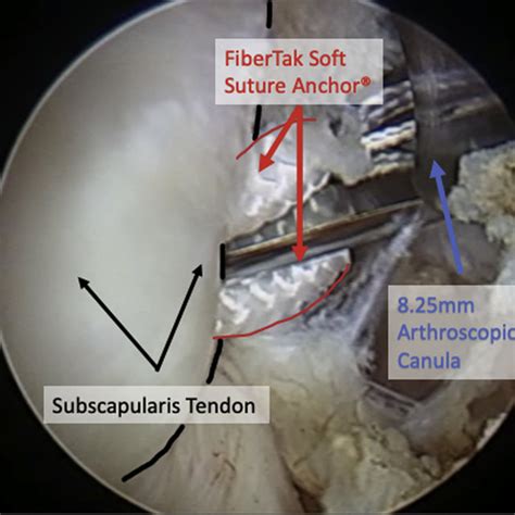 Patte Classification Of Full Thickness Rotator Cuff Tear A Stage 1 Download Scientific
