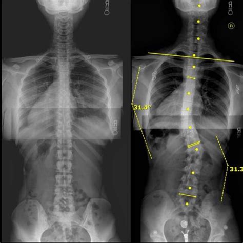 Scoliosis Before And After Chiropractic
