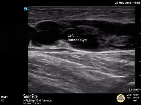 Musculoskeletal — Tpa